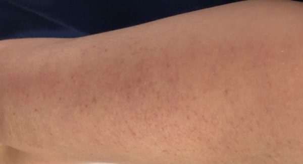 Rough Bumpy Skin -Keratosis Pilaris -Speckled Red Skin