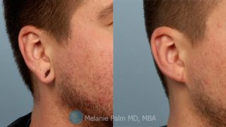 Cellulite Treatment -Cellutone Before and After Photos