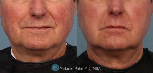 IPL Photofacial, Intense Pulsed Light Skin Rejuvenation - Art of Skin