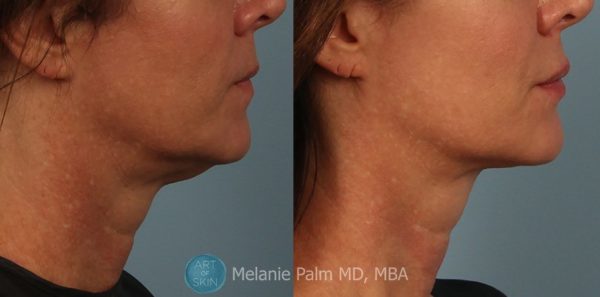 Kybella San Diego -Double Chin Treatment San Diego