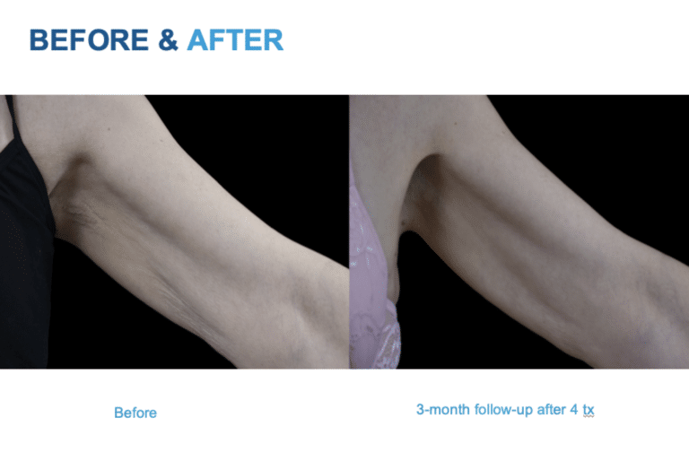 Emtone San Diego -Cellulite and Skin Tightening Treatment