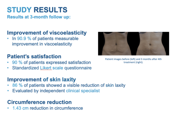 Emtone San Diego -Cellulite and Skin Tightening Treatment