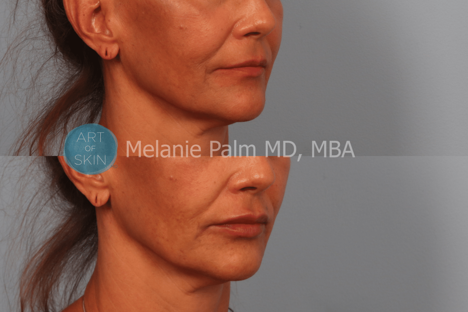 Restylane Kysse Lip Filler Injections -San Diego Restylane