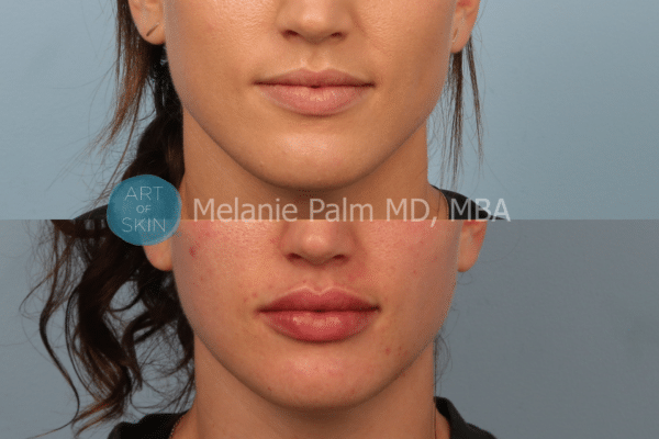 Restylane Kysse Lip Filler Injections -San Diego Restylane