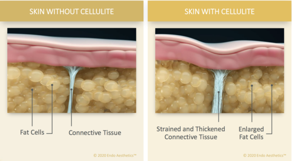 Cellulite Causes -Cellulite Treatment Options -Qwo San Diego