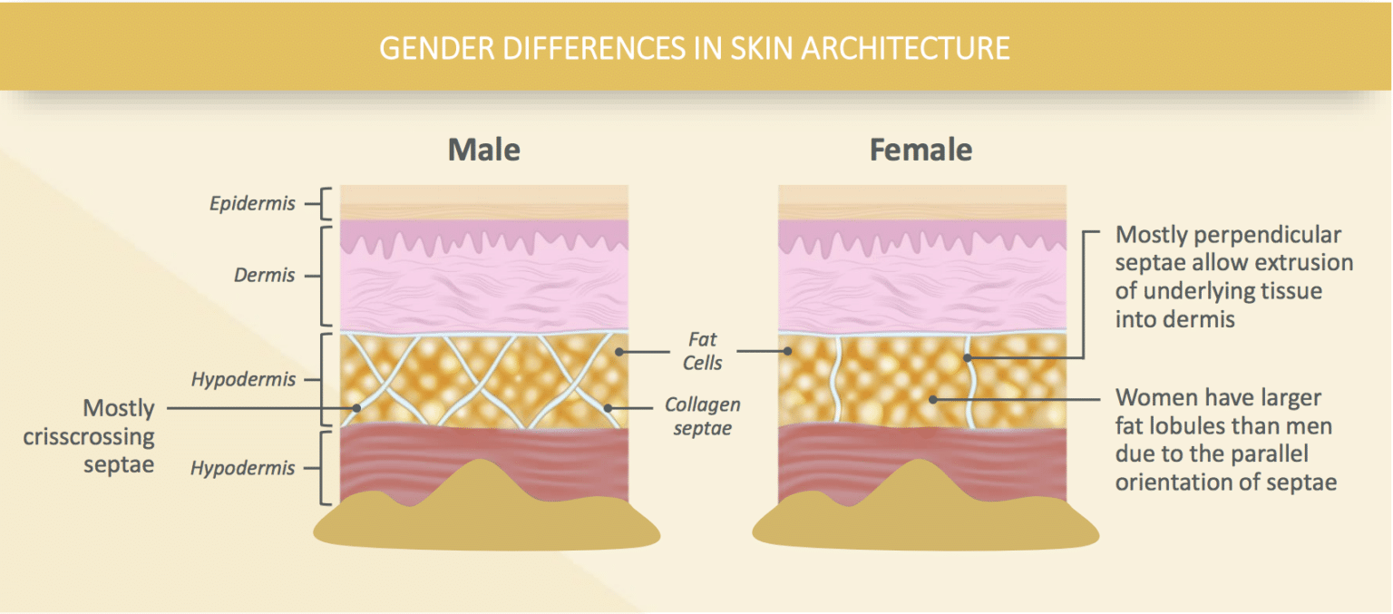 Cellulite Causes - Cellulite Treatment Options - Qwo San Diego