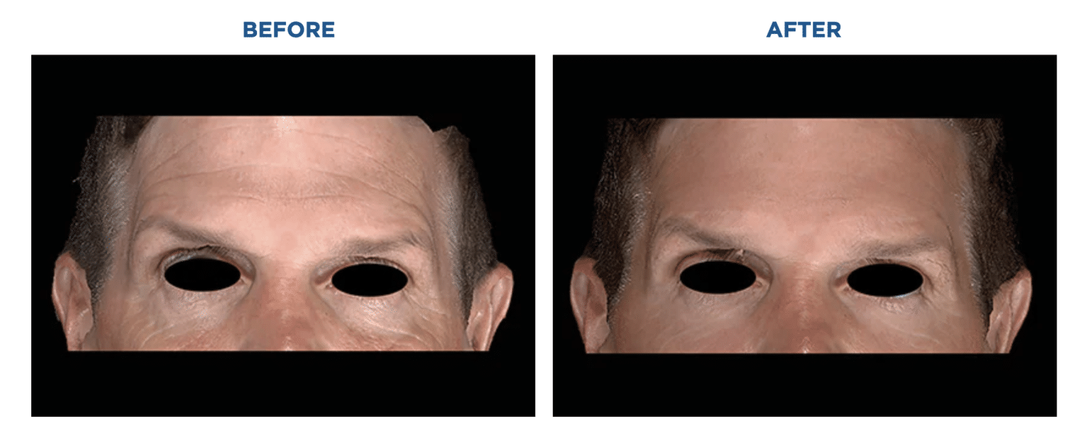 EMFACE Facial Muscle Toning & Skin Tightening and Lifting San Diego