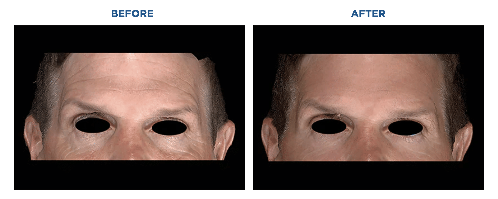 Emface Enhanced Facial Muscle Toning & Skin Tightening and Lifting