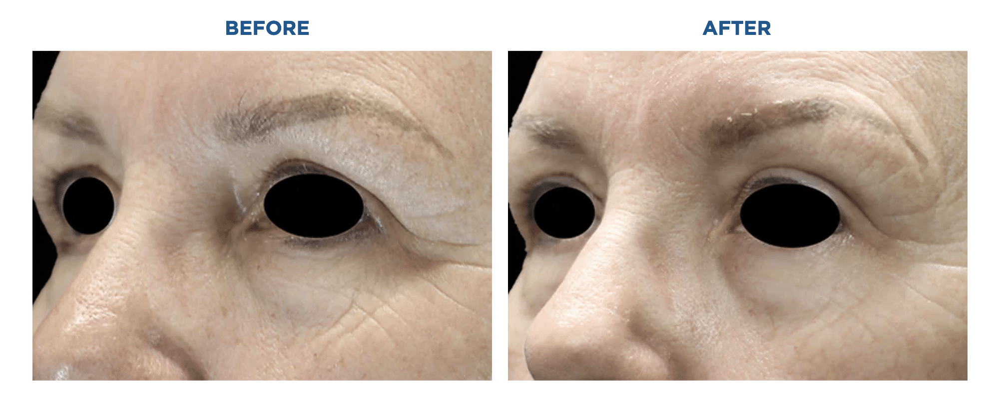 Emface Enhanced Facial Muscle Toning & Skin Tightening and Lifting