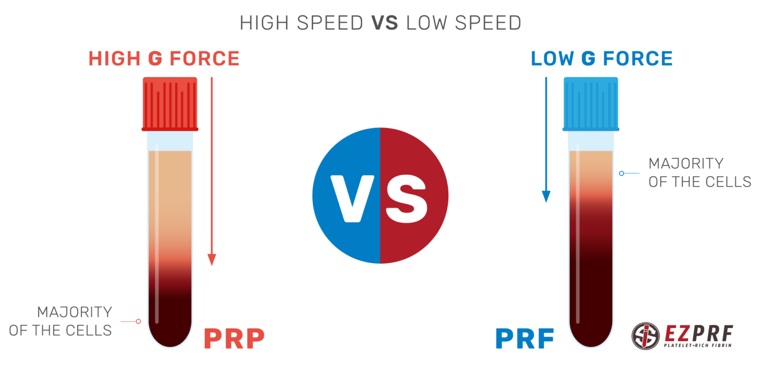 Plasma Rich Fibrin (PRF) and EZgel Procedures in San Diego