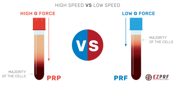 Plasma Rich Fibrin (PRF) and EZgel Procedures in San Diego