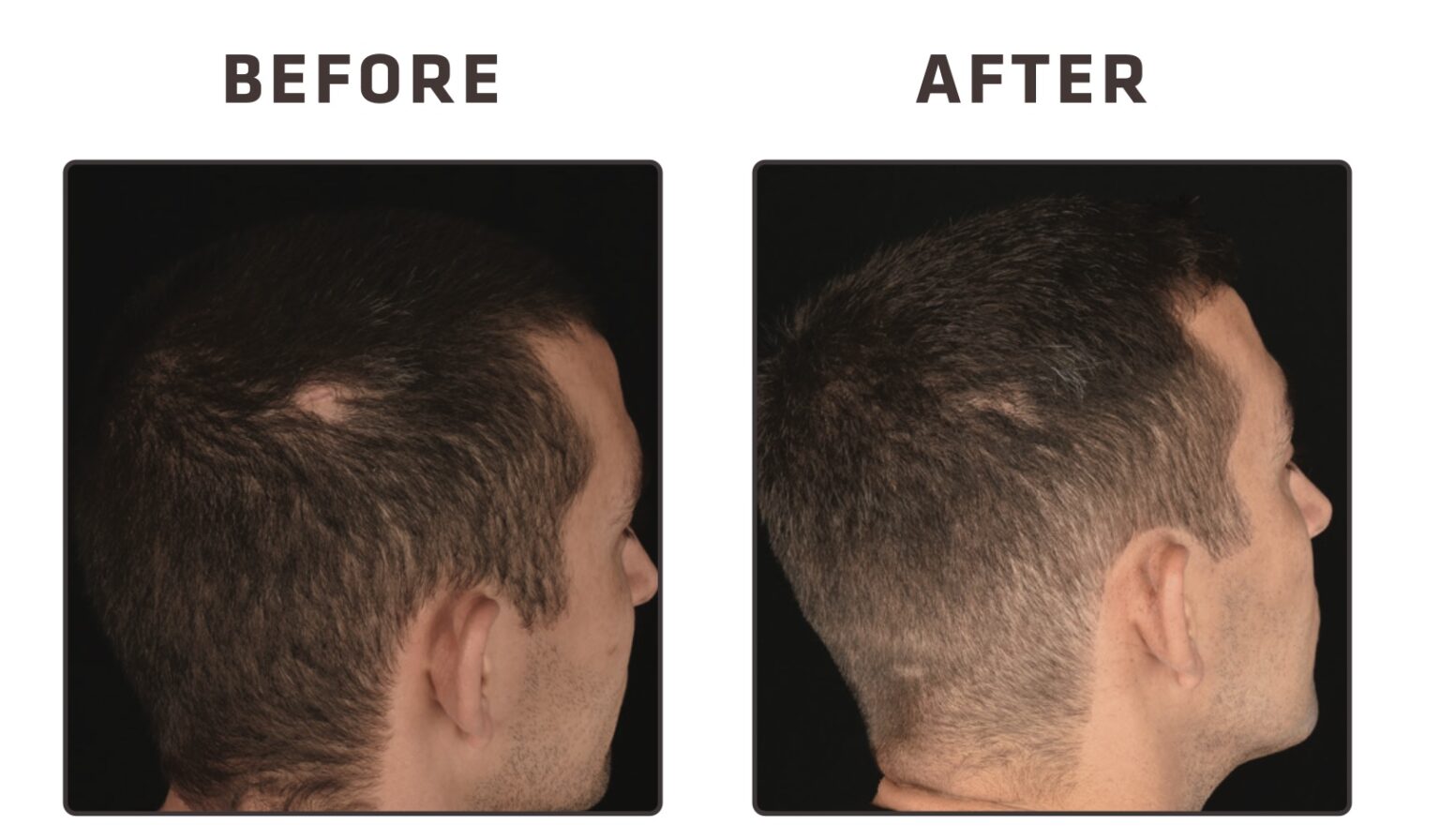 Plasma Rich Fibrin (PRF) and EZgel Procedures in San Diego