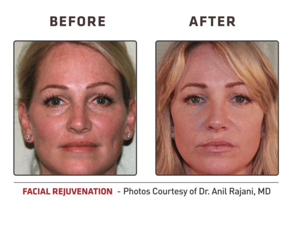 Plasma Rich Fibrin (PRF) and EZgel Procedures in San Diego