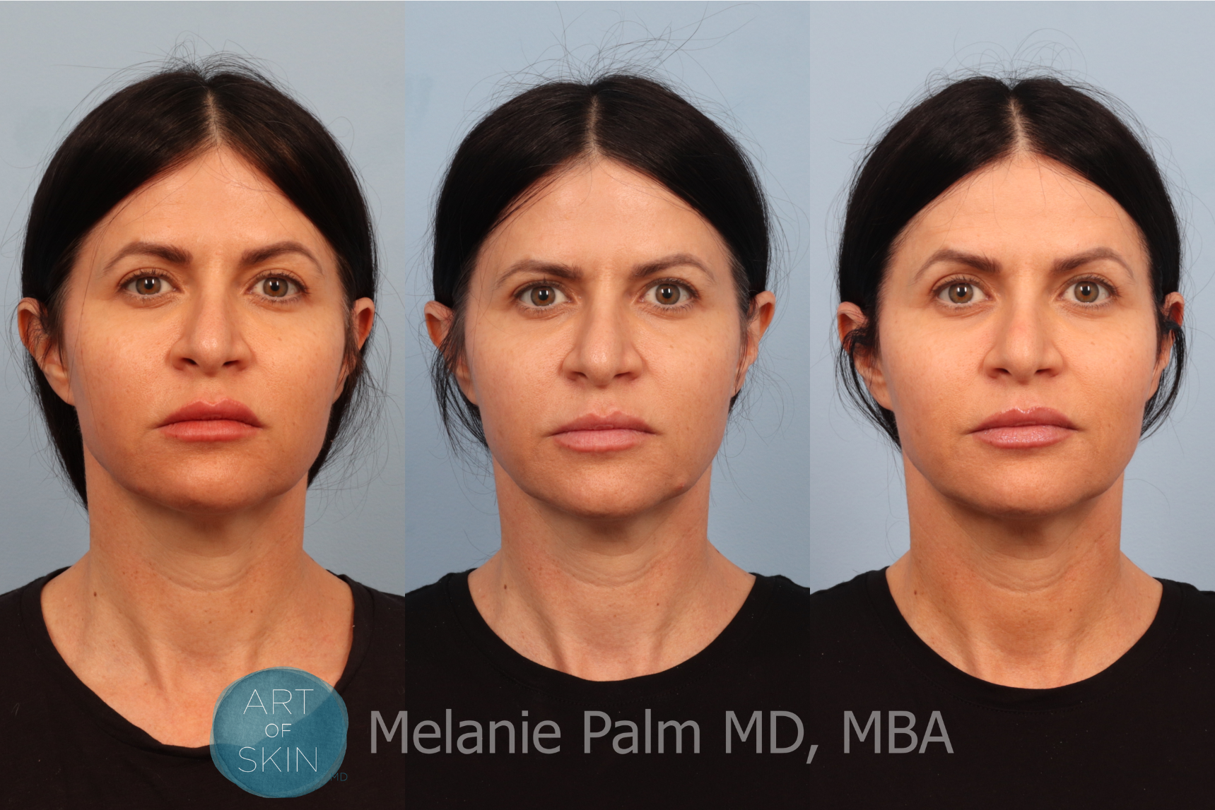 EMFACE Facial Muscle Toning & Skin Tightening and Lifting San Diego
