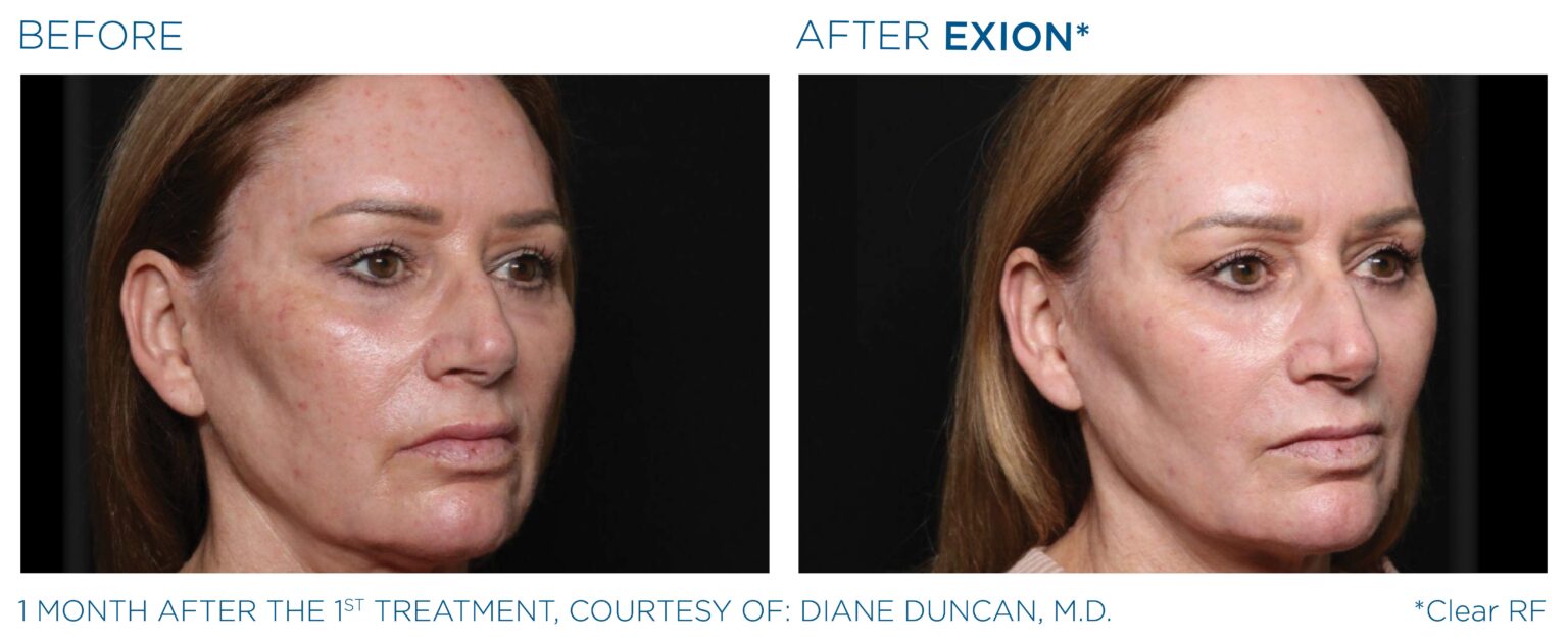 Exion Clear and RF Microneedling San Diego