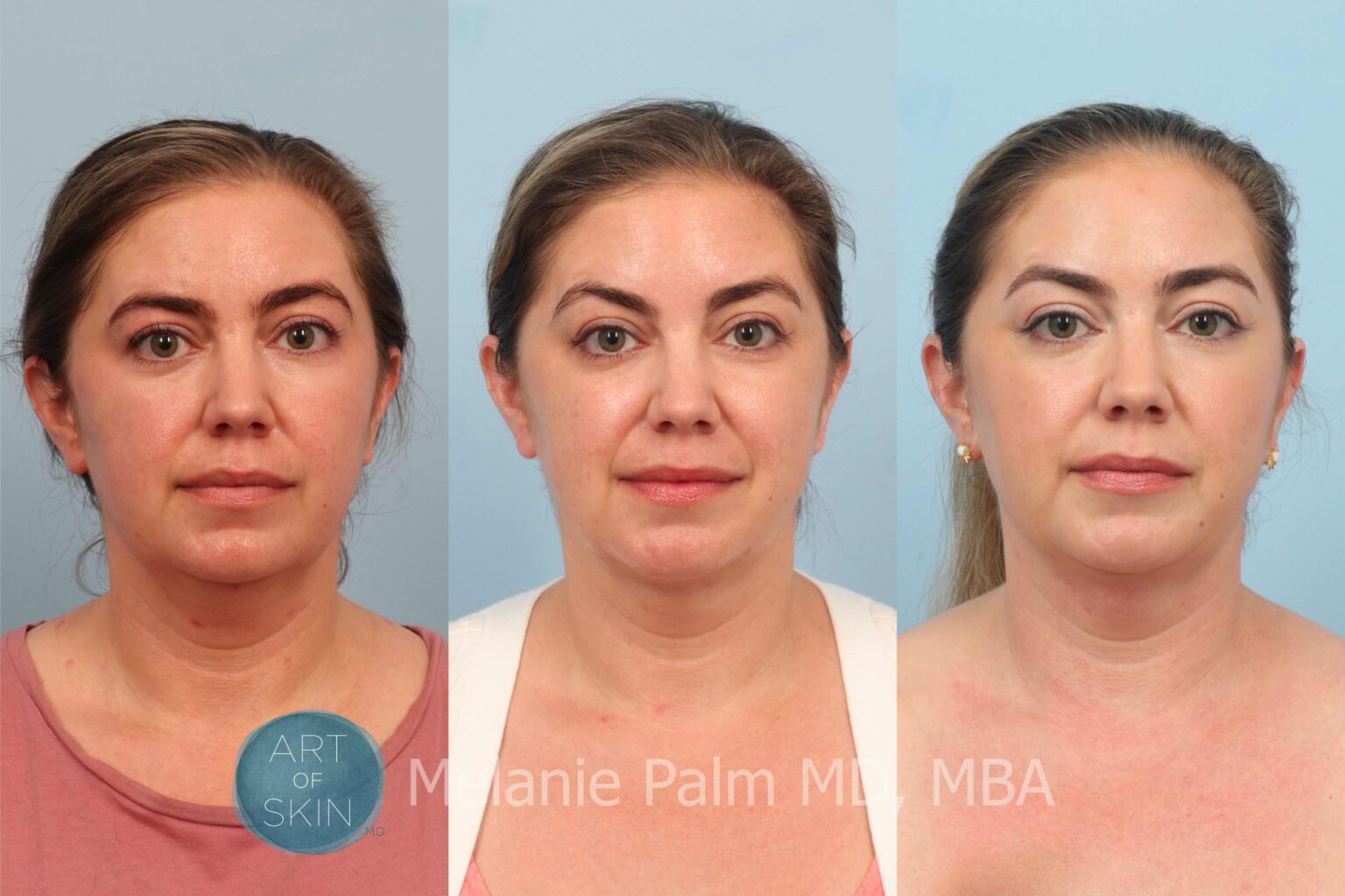 EMFACE Facial Muscle Toning & Skin Tightening and Lifting San Diego