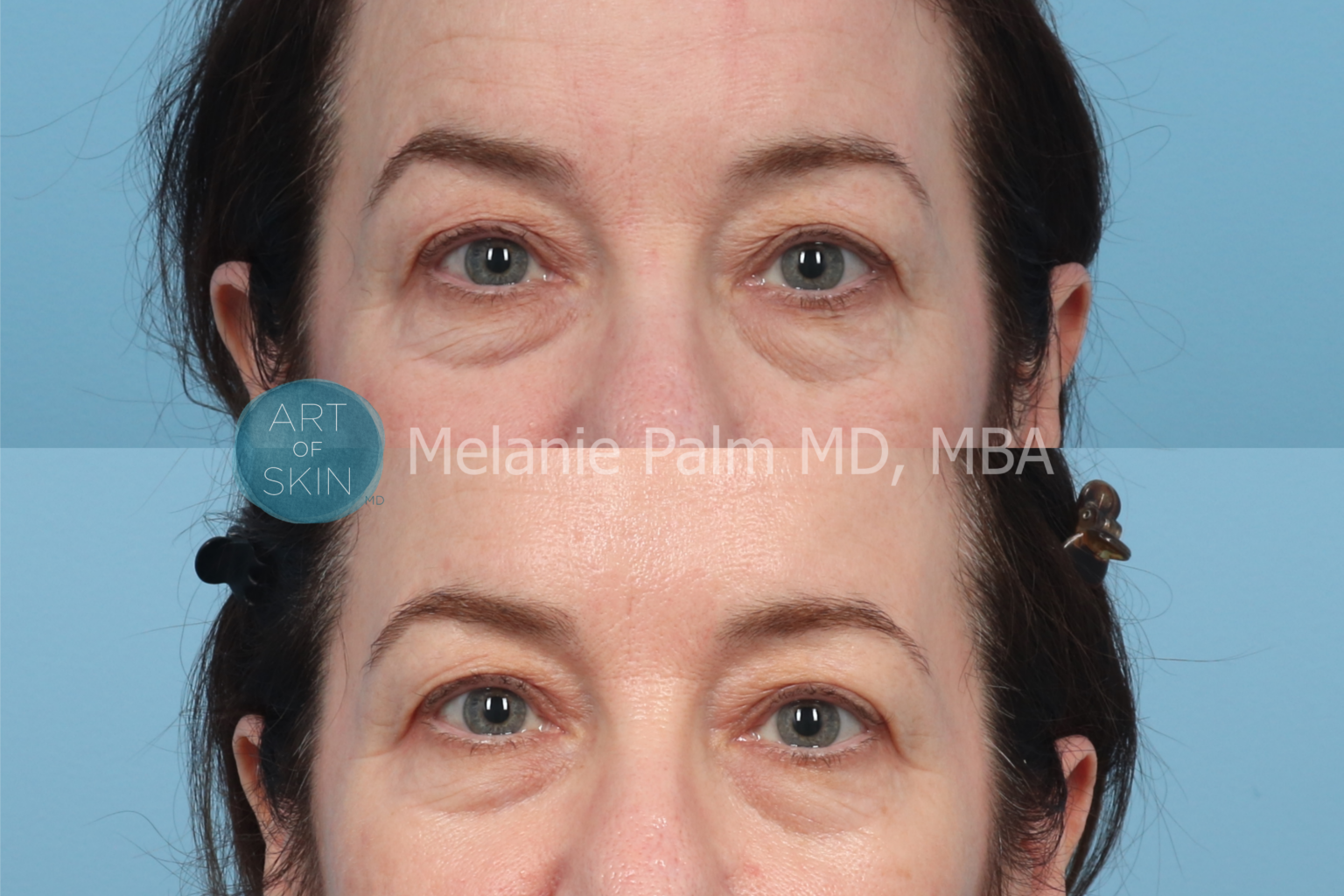 EMFACE Facial Muscle Toning & Skin Tightening and Lifting San Diego